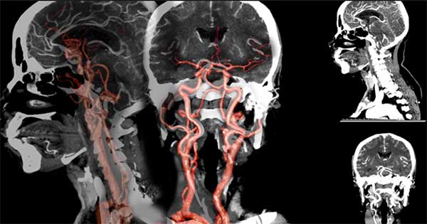 El Angiotac o angiografía por tomografía computarizada