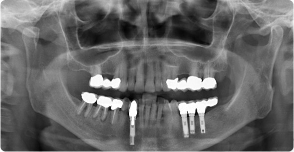 La Tomografía Axial Computarizada para implantes dentales o Dentascan ...