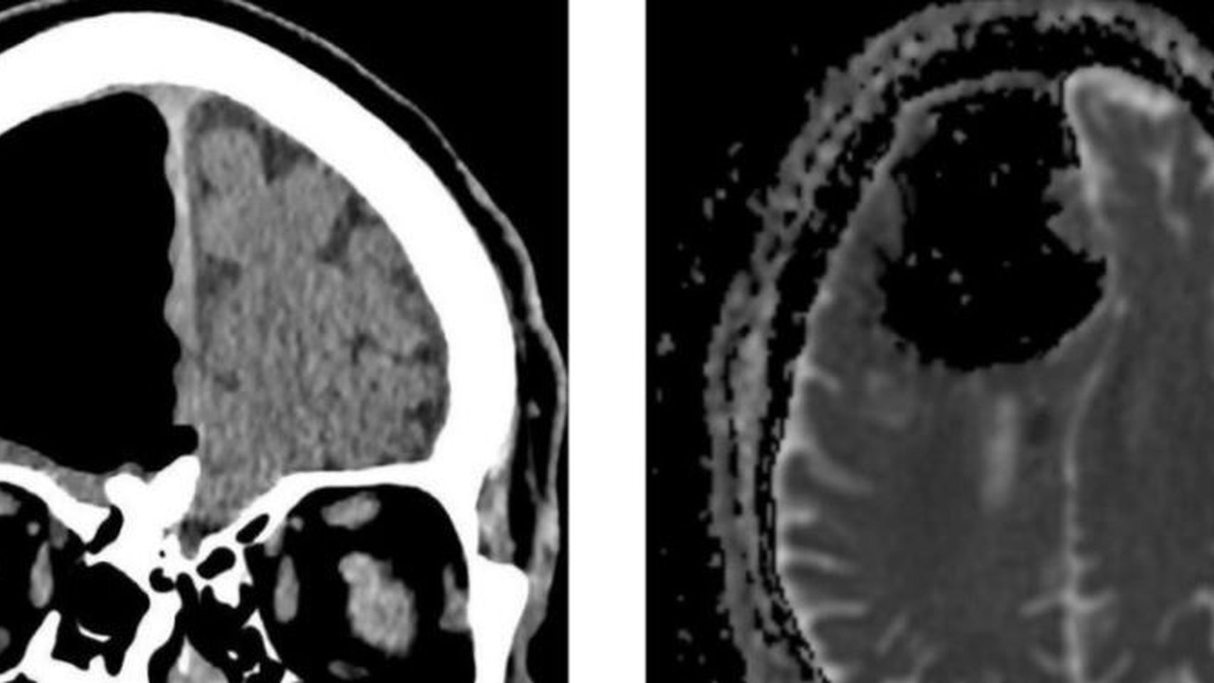 Descubren un agujero en el cerebro gracias a un TAC Cerebral
